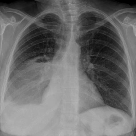 Chest X Ray Showing The Presence Of Solid Mass Peripherally In The