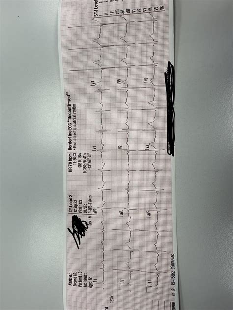 Pvc Trigeminy R Ekgs