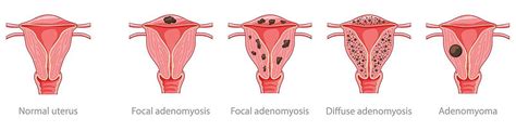 Focal Adenomyosis Human Anatomy Female Reproductive System Diagram With Text Sick And Normal