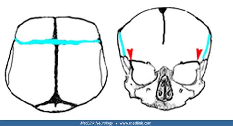Bilateral Lambdoid Craniosynostosis