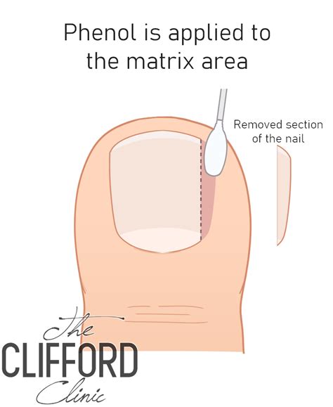Partial Nail Avulsion Ingrown Toenail Removal Surgery
