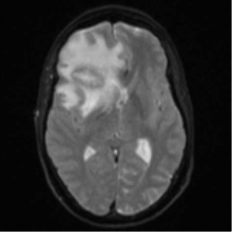 Cerebral Abscess Radiopaedia 60342 68009 Axial Dwi Nc Commons
