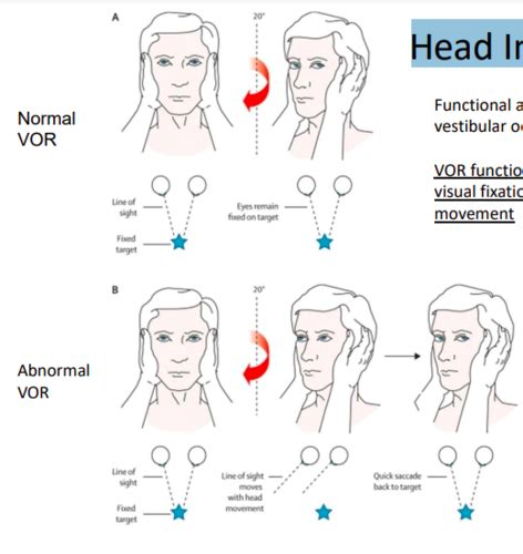 Assessment Of The Vestibular Patient Flashcards Quizlet