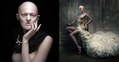 This Model With A Genetic Disorder Is Breaking The Constraints Of The Fashion Industry