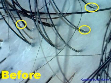 I Tried Puri Scalp Mask Meridian Herbal Treatment Due To Hair Loss After Lots Of Late Nights