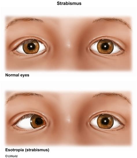 Amblyopia Ophthalmology Uworld Medical Library