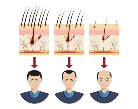 The Efficacy Of Dutasteride Lyphar Provide Competitive Price