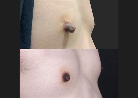 Nipple Reshaping In Beverly Hills And Los Angeles Zamani Plastic Surgery