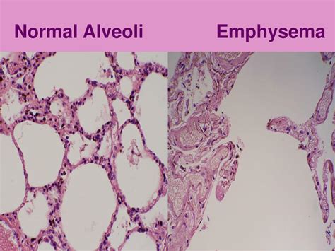 Ppt Emphysema Powerpoint Presentation Free Download Id2746705