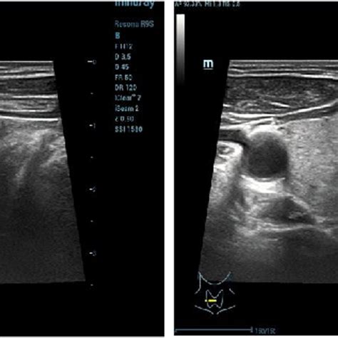 The Right Thyroid Nodule With The Maximum Diameter Of 19 Mm In A
