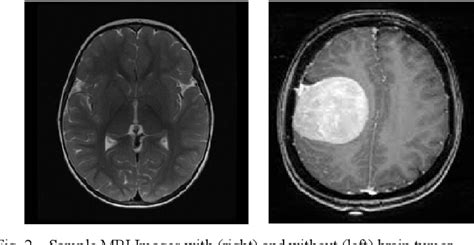 Figure 2 From Detection Of Brain Tumors From Mri Images Using Convolutional Neural Networks