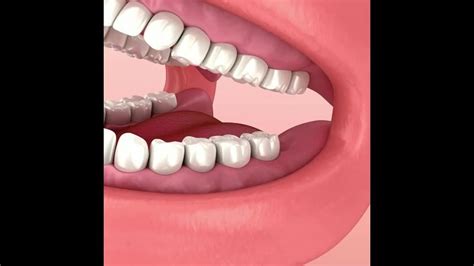 Короткий видеоролик о появлении капюшона в районе зубов мудрости Это не что иное как