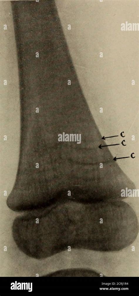 Fracture De La Jambe Banque De Photographies Et Dimages à Haute