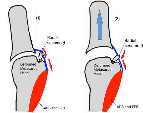 If Reduction Of The Locking Is Simply Performed Under A Tension Force Download Scientific