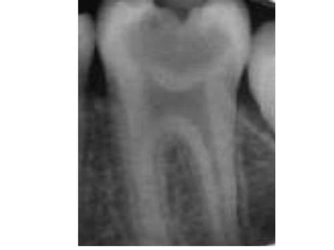 Direct And Indirect Pulp Capping Pptx Dental Health Diseases And Conditions