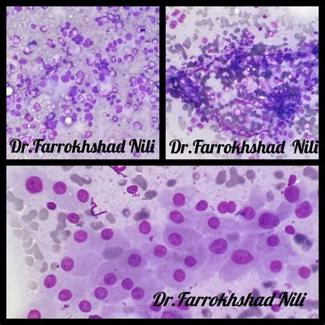 Farrokhshad Nili On Linkedin Thyroid Nodule Aspiration 35 Yo Femaleisoechoic Indistinct Solid