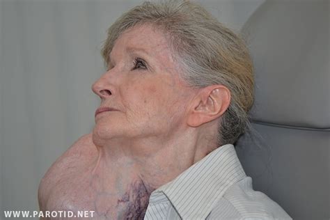 Parotid Gland Tumor Pictures For Surgery
