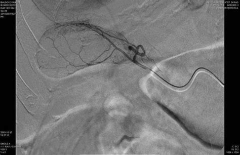 Embolization Of A Bleeding Duodenal Ulcer In A Patient With Vascular Anomaly Eurorad