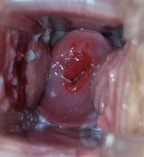 Age 25 Iud And Ectropion Most Of Cycle Beautiful Cervix Project