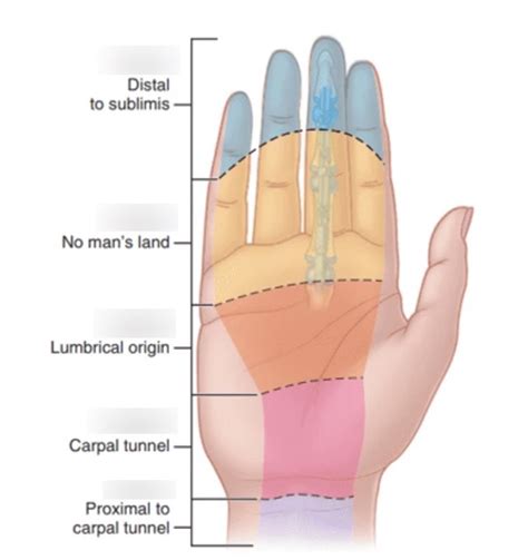 Flexor Tendon Zones Diagram Quizlet