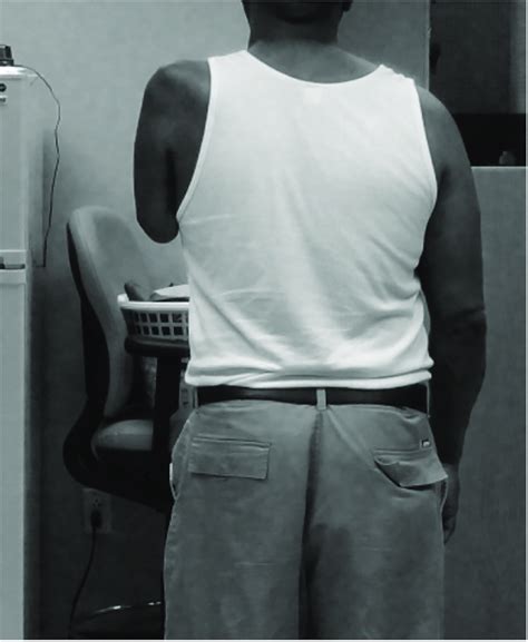 Subject 2 Posterior View Of Residual Limb Download Scientific Diagram