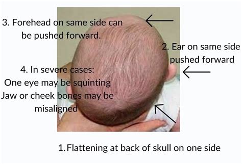Plagiocephaly Positional Plagiocephaly Flat Head 58 Off