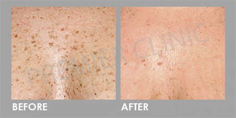 Remove Skin Imperfections With PICO Laser