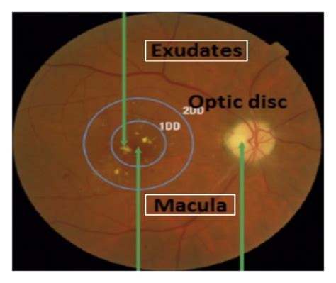 Macula Exudates And Optic Disc In Fundus Image Download Scientific Diagram