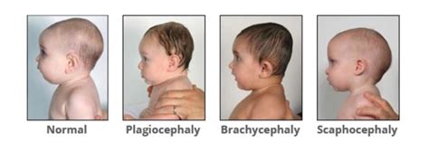 Scaphocephaly