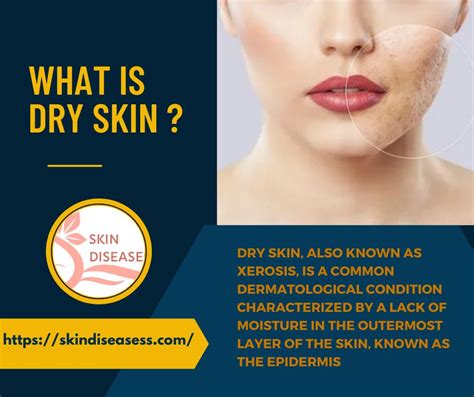 Skin Diseases On Linkedin What Is Dry Skin Dry Skin Also Known As Xerosis Is A Common…