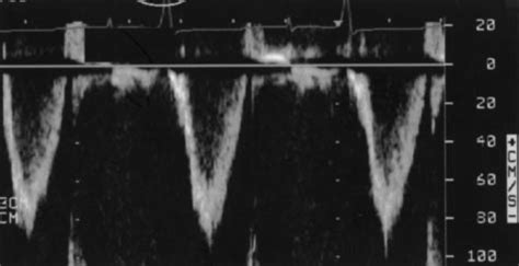 A Continuous Doppler Flow Pattern Is Shown Permitting The Assessment Download Scientific