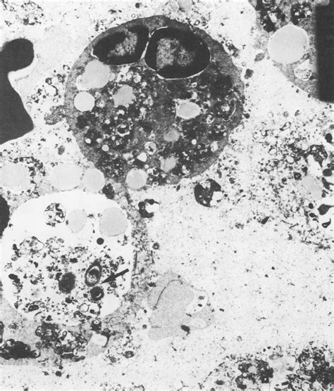 Electron Micrograph Showing Degenerating Polymorphonuclear Leukocytes Download Scientific
