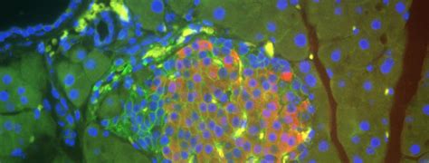 Wolfram Research Wolfram Syndrome International Registry And Clinical
