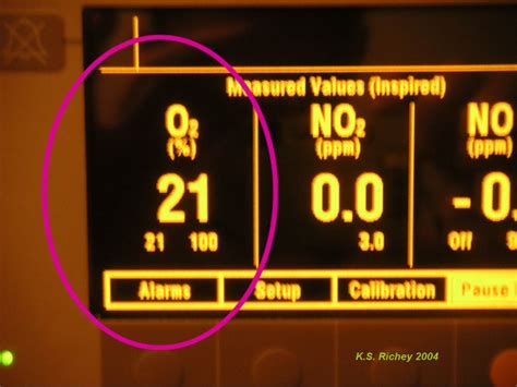 FREMITUS Inhaled Nitric Oxide Set Up For Nitric Oxide Challenge