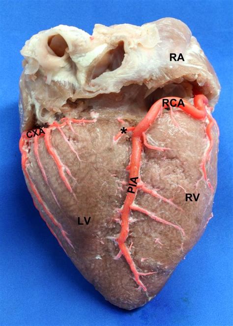 Interventricular Sulcus And Septum Interventricular Sulcus And Septum