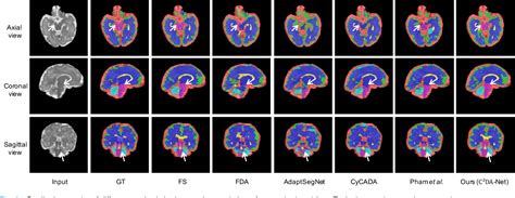 Figure 1 From Tissue Segmentation Of Thick Slice Fetal Brain Mr Scans