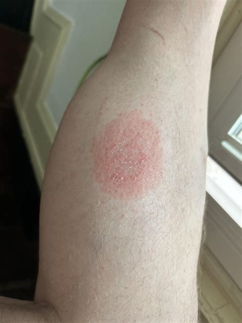Advice For Ringworm Washing And Ketoconazole Cream Application R