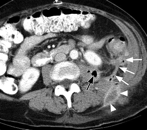 Ct Imaging Of Colitis Radiology