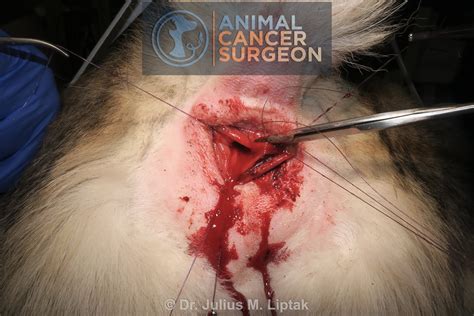 Rectal Adenocarcinoma Resected Via A Rectal Eversion And Submucosal