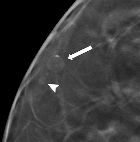 Calcifications At Digital Breast Tomosynthesis Imaging Features And Biopsy Techniques
