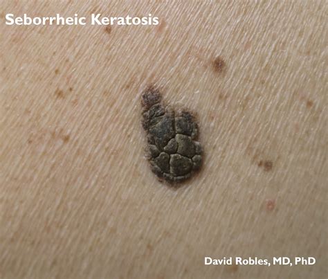 Seborrheic Keratoses Some People Call Them Age Spots I Call Them