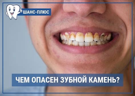 ЗАМЕЧАЛИ У СЕБЯ НА ЗУБАХ ЖЕЛТО КОРИЧНЕВЫЕ ПЯТНА Это зубной камень Он представляет собой