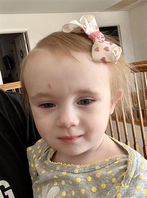 Fionas Story Edwards Syndrome Association