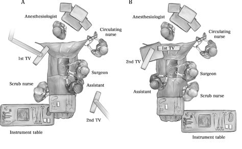 Uniportal Video Assisted Thoracoscopic Right Upper Lobectomy Operative Techniques In Thoracic