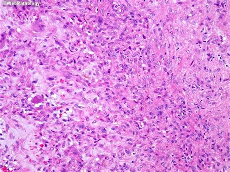 Chondromyxoid Fibroma