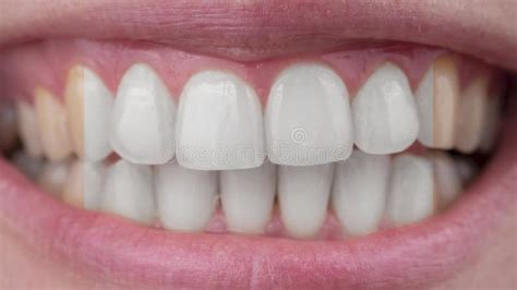 Close Up Of A Woman S Smile Before And After Teeth Whitening Stock Video Video Of Gypsum