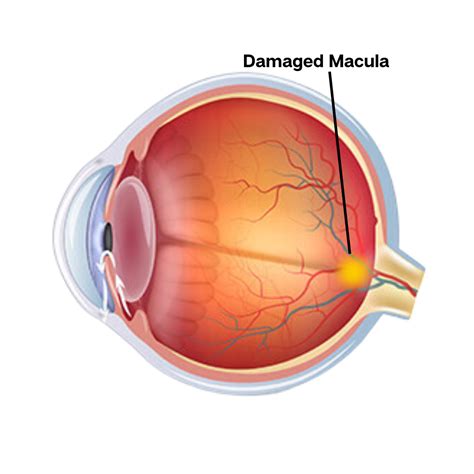 Ocular Disease Optometrist Paducah Kentucky Eye Doctor Paducah Ky