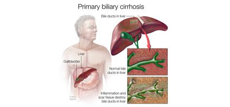 Primary Biliary Cirrhosis Treatment Dr Kiran Peddi