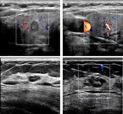 Thyroid Ultrasound And Breast Ultrasound A Preoperative Thyroid