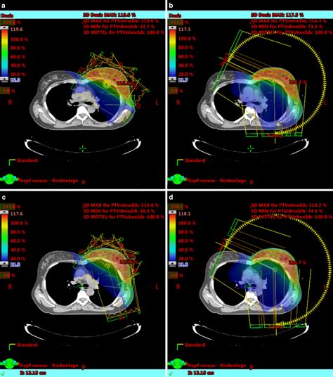 Beam Arrangement And Isodose Distribution Of Both Vmat And Imrt Plans